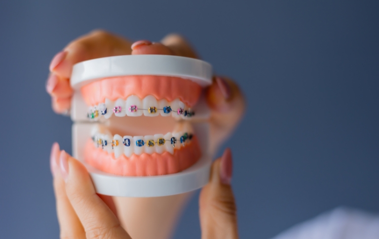 Types of Braces Explained—Features, Benefits and Cost | Park Lane ...
